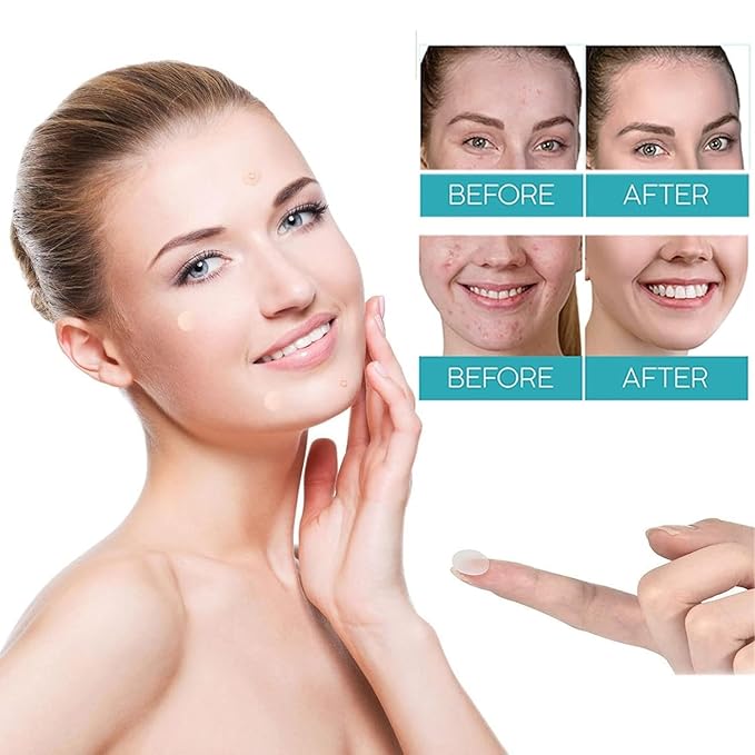 3229 Acne Patch Face Pimple Patch 1 Sheet Pack of 36 Pimple Healing ...